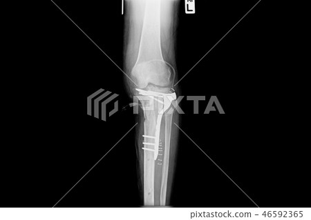 internal of left leg fixed with plate and screws. - Stock Photo ...