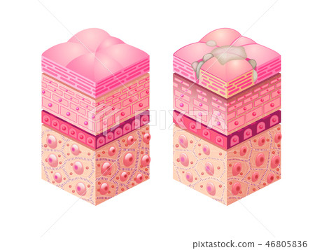 Image of skin surface stained with sebum - Stock Illustration [46805836 ...