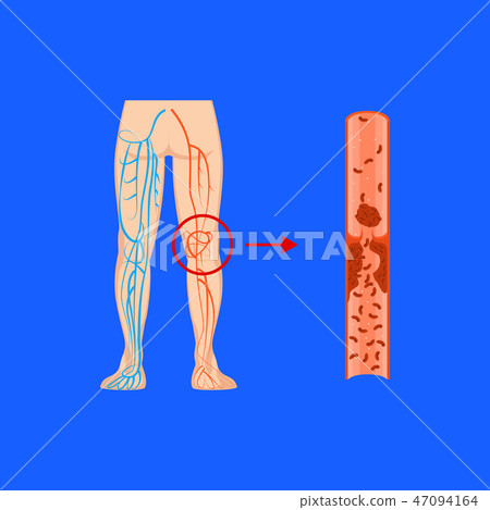 Cartoon Deep Vein Thrombosis Card Poster. Vector - Stock Illustration ...