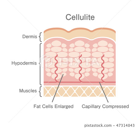 Sectional illustration of skin where cellulite... - Stock Illustration ...