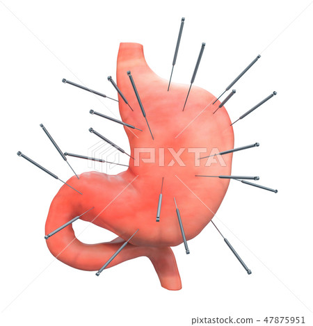 Human stomach with acupuncture needles - Stock Illustration [47875951 ...