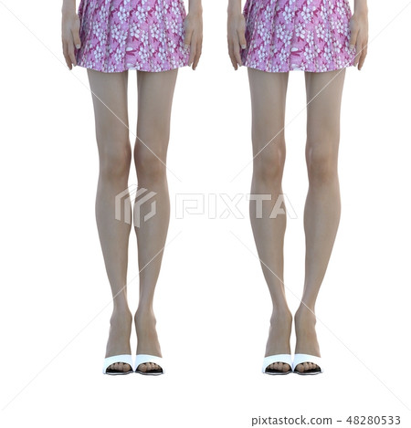 Normal legs and legs of O legs Before after - Stock Illustration ...