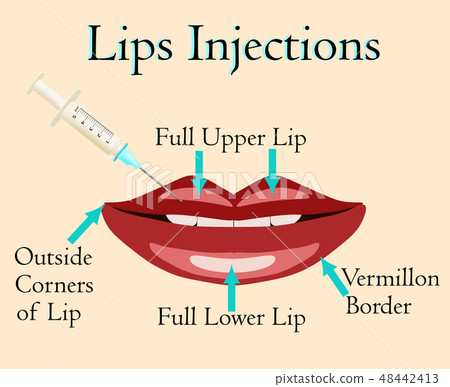 Lips injection vector illustration - Stock Illustration [48442413] - PIXTA