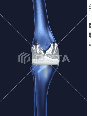 Artificial knee joint or knee implant - Stock Illustration [49408459 ...