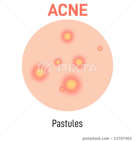 Pastules skin acne type - Stock Illustration [53707403] - PIXTA