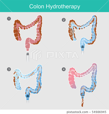 Colon Hydrotherapy.The secreted of waste that - Stock Illustration ...