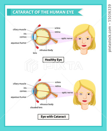 Scientific medical illustration of cataract of - Stock Illustration ...