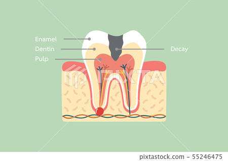 decay tooth anatomy structure - Stock Illustration [55246475] - PIXTA
