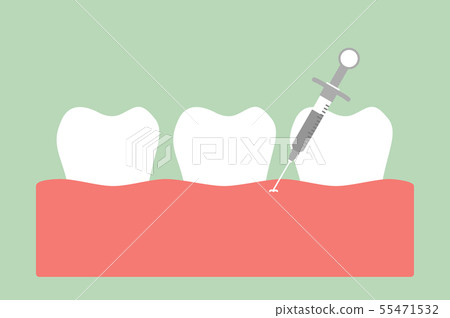 dental injection for tooth extraction - Stock Illustration [55471532 ...