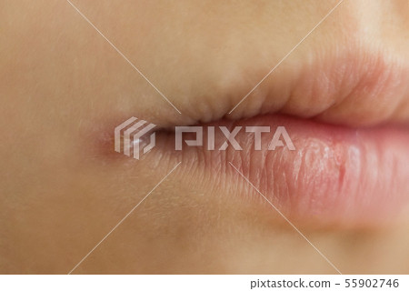 skin problems, angulitis, angular stomatitis, - Stock Photo [55902746 ...