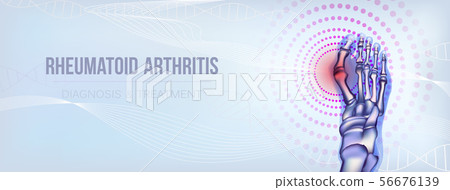Rheumatoid arthritis bones concept - Stock Illustration [56676139] - PIXTA