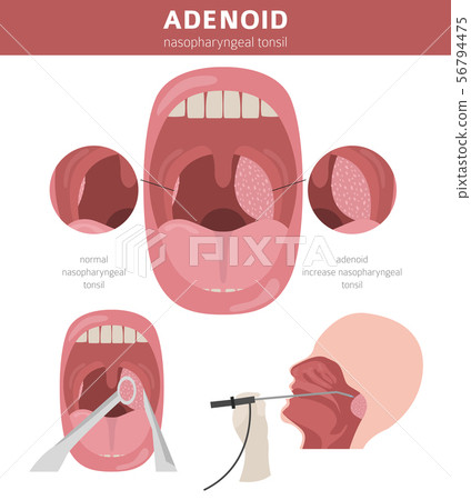 Nasal and throat, nasopharynx diseases. Adenoids - Stock Illustration ...