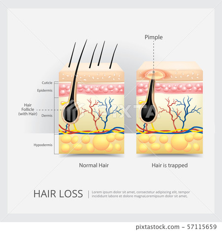 Hair Loss Structure Vector Illustration-插圖素材 [57115659] - PIXTA圖庫