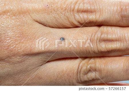 Black mole on woman's middle of finger, Close... - Stock Photo ...