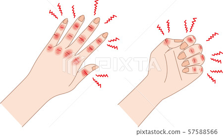 Chapped - Stock Illustration [57588566] - PIXTA