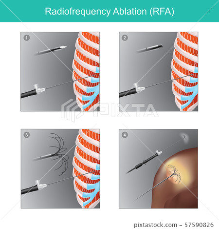 Radio frequency Ablation (RFA). Illustration info - Stock Illustration ...