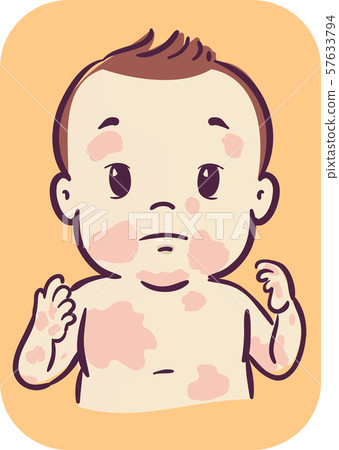 Baby Skin Rashes Illustration - Stock Illustration [57633794] - PIXTA