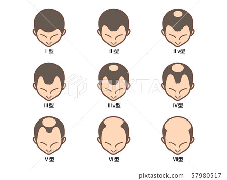Classification of male pattern baldness - Stock Illustration [57980517 ...