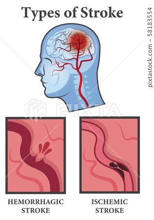 Vector illustration of Brain Stroke Types.... - Stock Illustration [58183554] - PIXTA