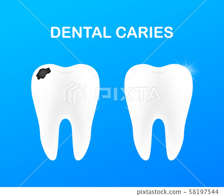 Stage of development of caries. Dental care - Stock Illustration ...
