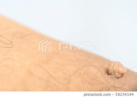 Pedunculated Skin Polyp Pedunculated Skin Polyp