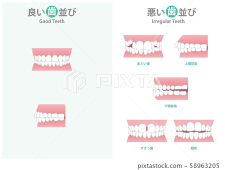 Illustration of good and bad teeth - Stock Illustration [58963205] - PIXTA