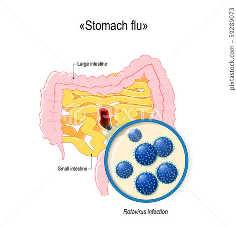 rotavirus infection or stomach flu. Small... - Stock Illustration ...
