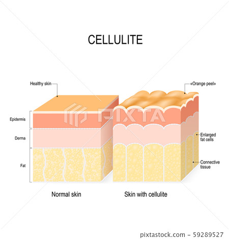 Cellulite Diagram