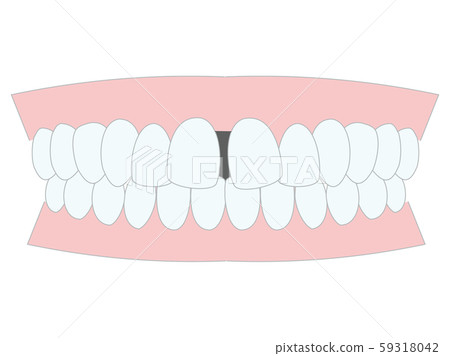 Malocclusion, midline separation, tooth alignment - Stock Illustration ...
