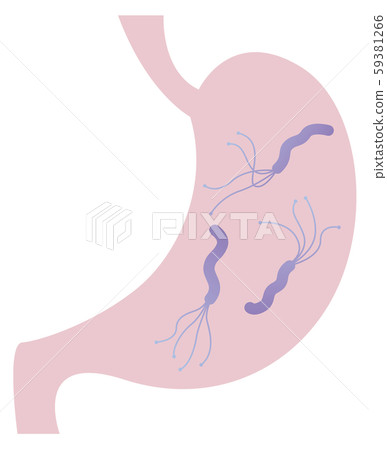 Stomach infected with Helicobacter pylori - Stock Illustration ...