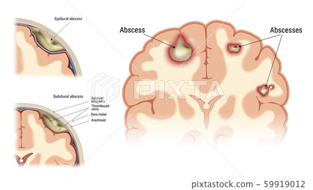 Abscess set vector - Stock Illustration [59919012] - PIXTA