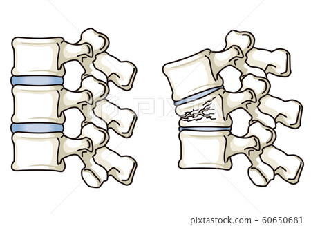 Illustration of compression fracture - Stock Illustration [60650681 ...