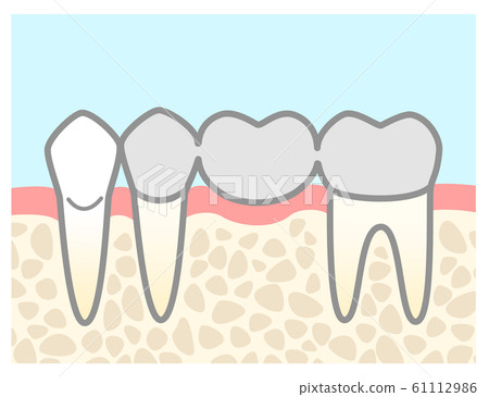 Bridge silver tooth illustration background... - Stock Illustration ...