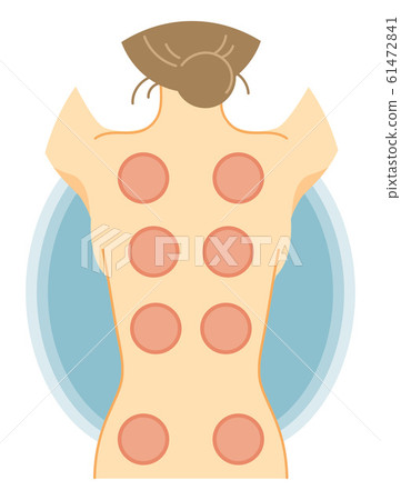 Cupping treatment mark (back) - Stock Illustration [61472841] - PIXTA