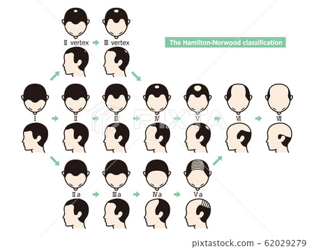 Hamilton Norwood Classification Bald - Stock Illustration [62029279 ...