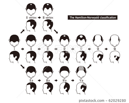 Hamilton Norwood Classification Bald - Stock Illustration [62029280 ...