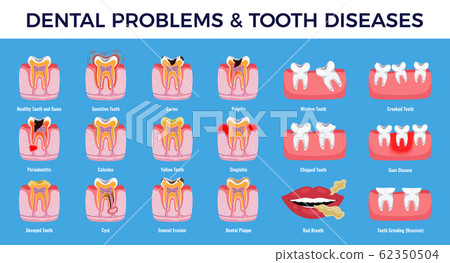 Dental Problems Diseases Infographic Set - Stock Illustration [62350504 ...