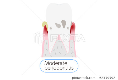 Illustration by stage of periodontal disease:... - Stock Illustration ...