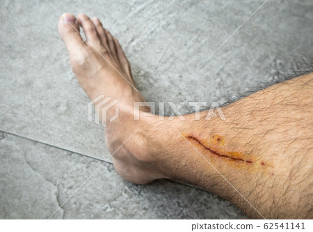 Man with long scab wound on his right leg - Stock Photo [62541141] - PIXTA