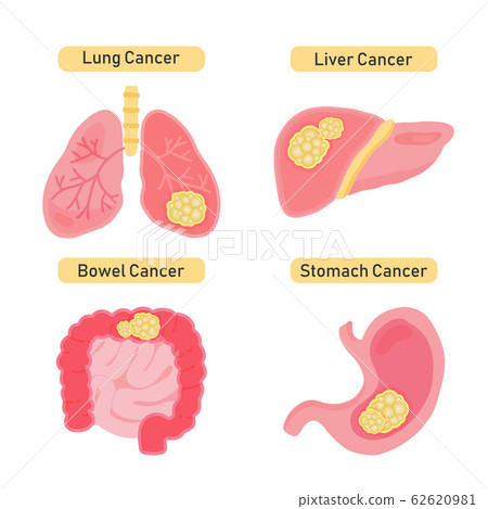 Cancer types flat vector illustration. - Stock Illustration [62620981 ...