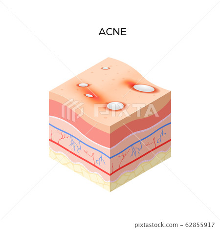 Acne vulgaris or pimple cross-section of human... - Stock Illustration ...