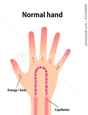 Illustration of normal healthy hand (cause of... - Stock Illustration ...