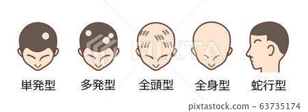 Alopecia areata Classification There are... - Stock Illustration ...