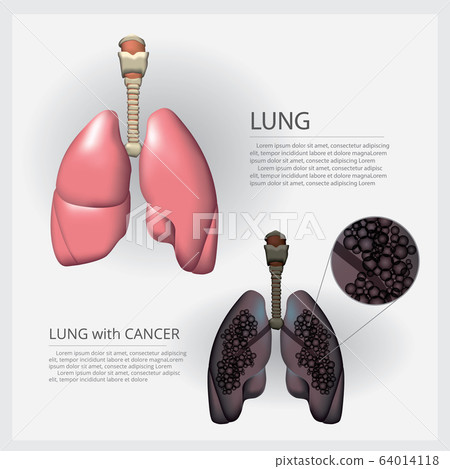 Lung with Detail and Lung Cancer Vector... - Stock Illustration ...