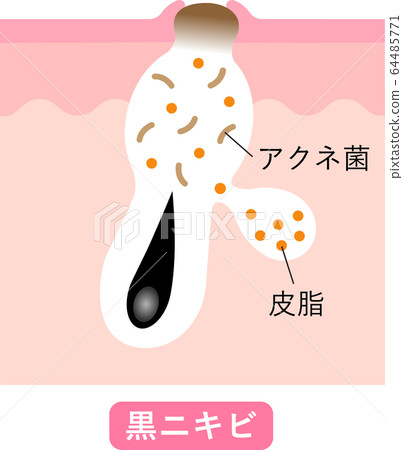 Cross section of black acne skin - Stock Illustration [64485771] - PIXTA
