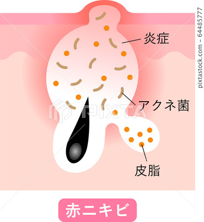 Red acne skin cross section - Stock Illustration [64485777] - PIXTA