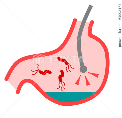 Gastroscope - Stock Illustration [65008471] - PIXTA
