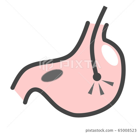 Gastroscope - Stock Illustration [65008523] - PIXTA