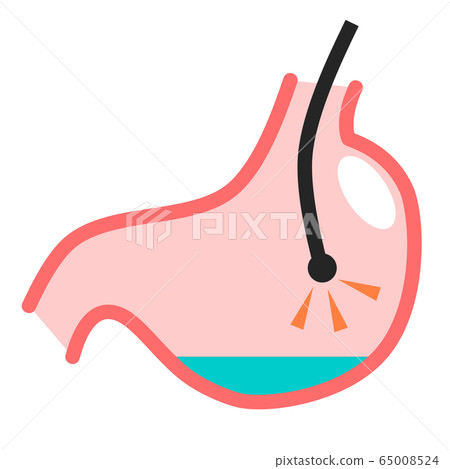 Gastroscope - Stock Illustration [65008524] - PIXTA