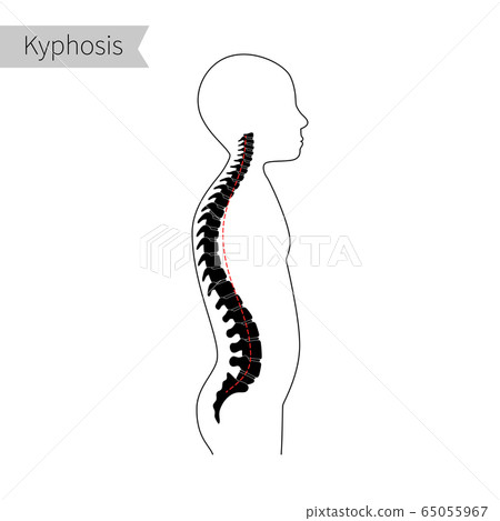 Kyphosis flat vector illustration. - Stock Illustration [65055967] - PIXTA